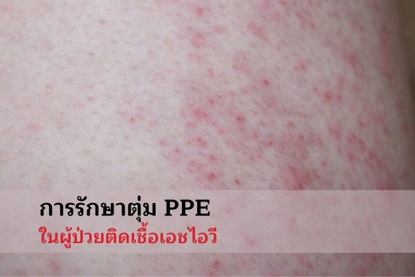 การรักษาตุ่ม PPE ในผู้ป่วยติดเชื้อเอชไอวี | ThaiHiv365